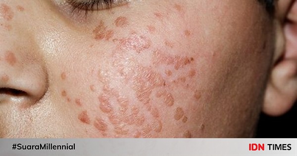 Mengenal Kutil, Gangguan Kulit yang Membuat Insecure