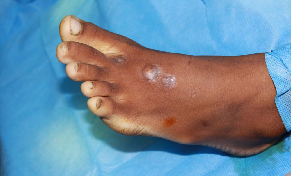 Mycetoma: Gejala, Penyebab, Diagnosis, dan Pengobatan