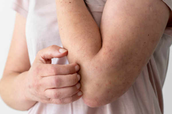 Ciri-ciri Ruam Kulit HIV, Kenali ya!