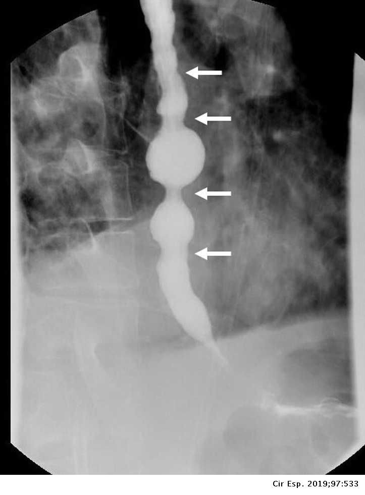 Disfagia: Penyebab, Jenis, Gejala, Pengobatan, Komplikasi