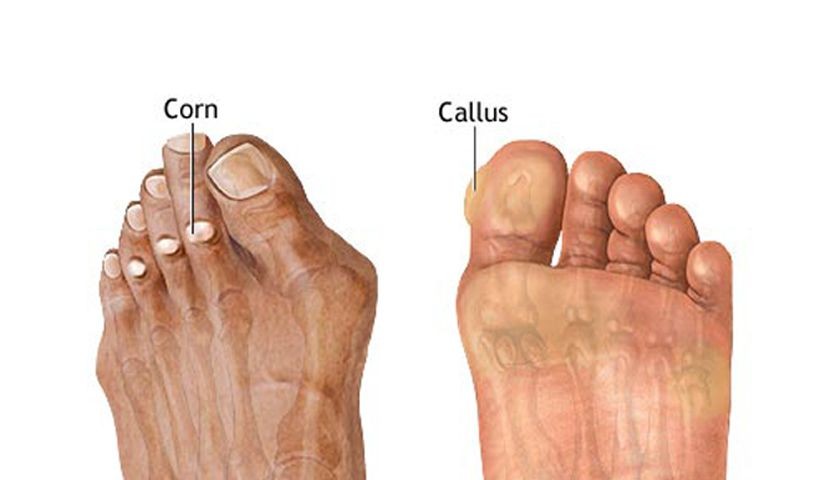 Kaki Jagung (Foot Corn): Penyebab, Gejala, Pengobatan