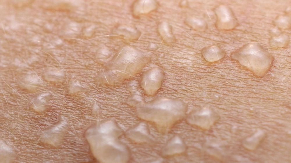 7 Gejala Sunburn, dari Kulit Mengelupas sampai Sakit Kepala