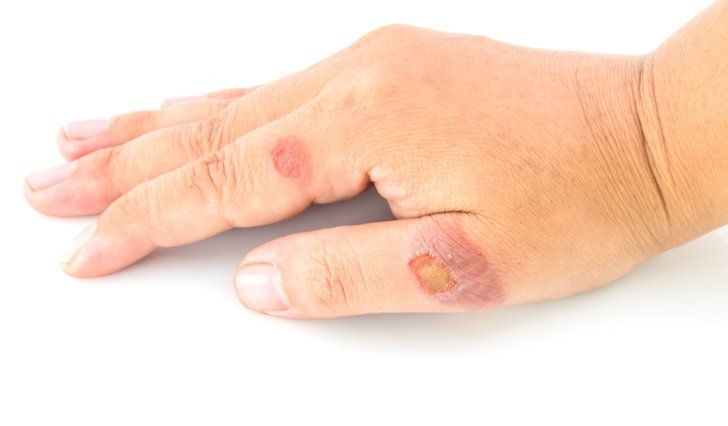 Pyoderma Gangrenosum: Gejala, Penyebab, dan Pengobatan