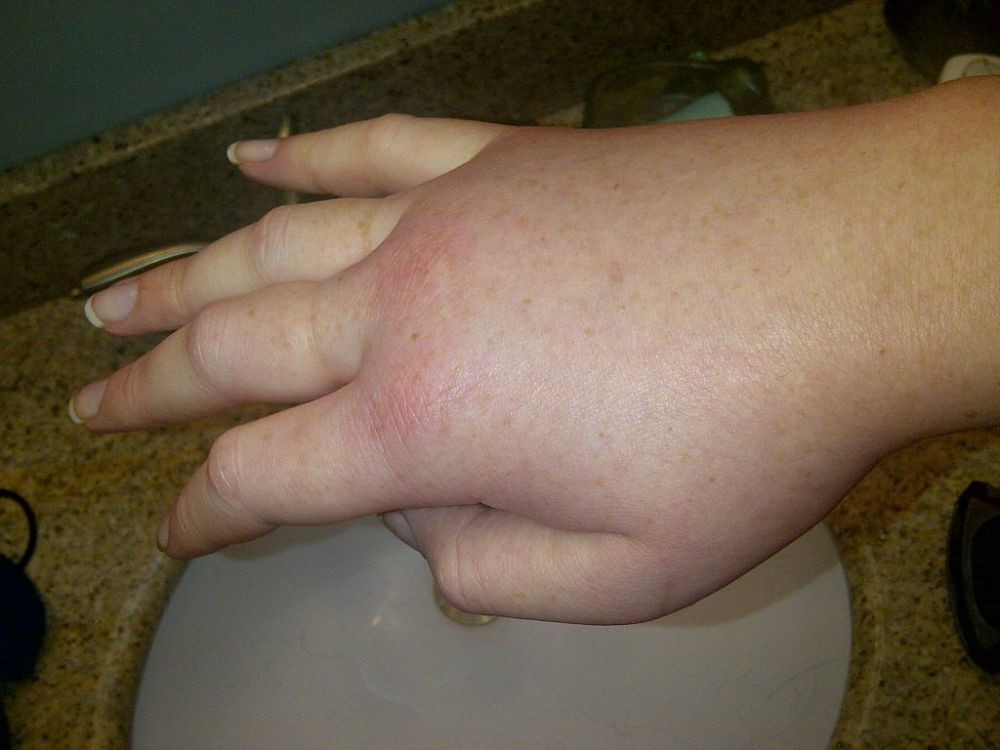 Angioedema: Jenis, Penyebab, Gejala, Komplikasi, Pengobatan