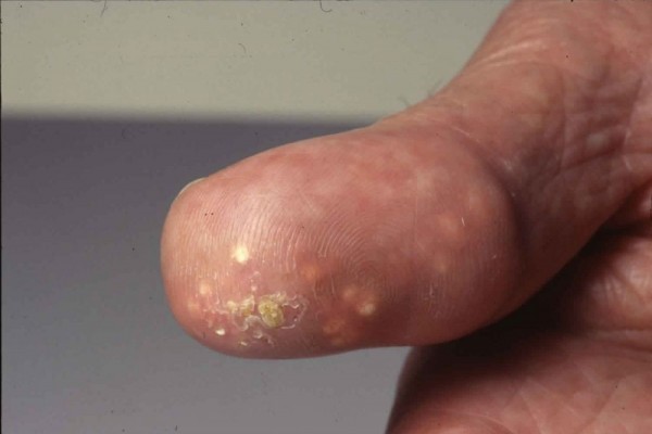 Calcinosis Cutis: Jenis, Penyebab, Gejala, dan Pengobatan