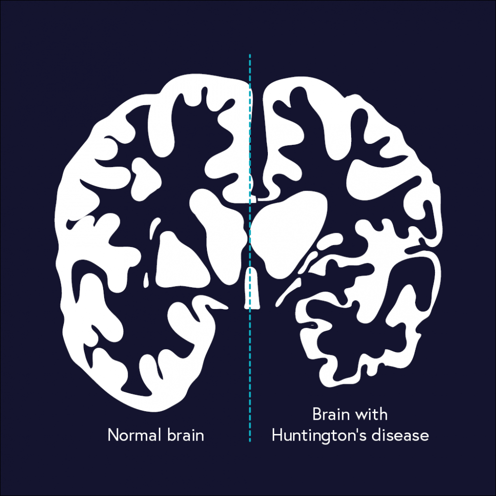 Huntington Disease Penyebab Gejala Komplikasi Pengobatan Huntington Disease Penyebab Gejala Komplikasi Pengobatan