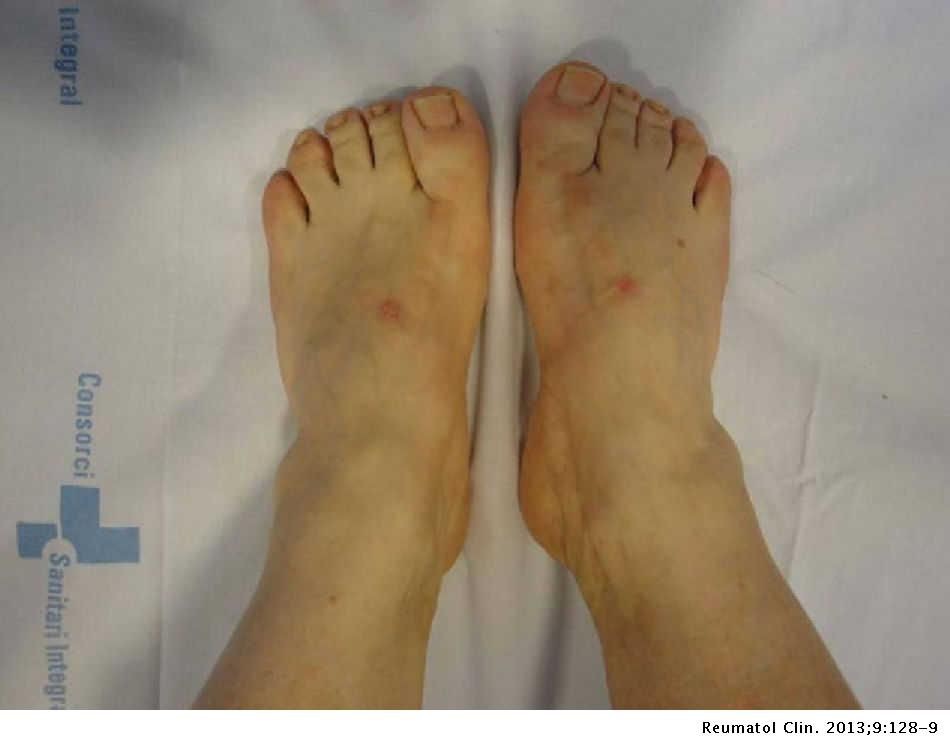 Akromegali: Penyebab, Gejala, Komplikasi, dan Perawatan