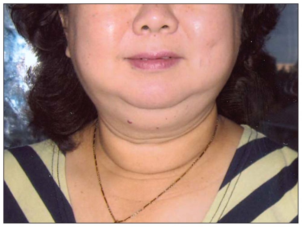 Moon Face: Penyebab, Gejala, Pengobatan, Pencegahan