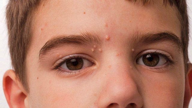 Moluskum Kontagiosum: Penyebab, Gejala, dan Pengobatan