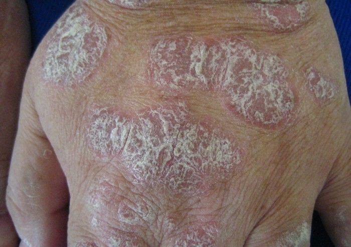 Psoriasis Vulgaris: Penyebab, Gejala, Diagnosis, Pengobatan